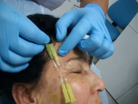 Dr. Nejat Can Organik İp Germe Sağ Kaz Ayağı - YouTube