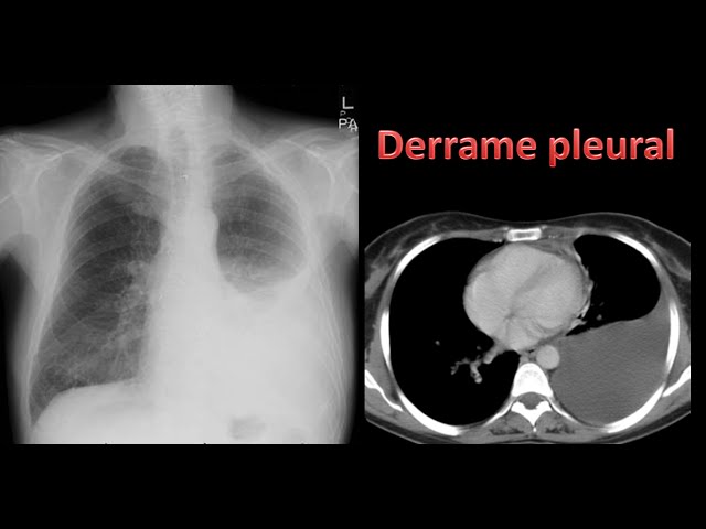 Radiografía De Tórax Derrame Pleural