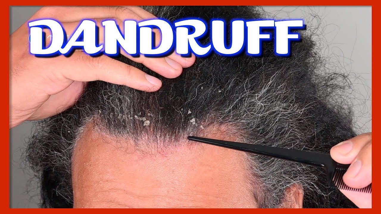 Dandruff Scratching Addiction | Natural Hair | PitaFlakes - YouTube