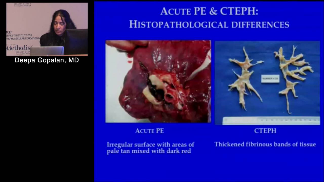 Multimodality Imaging of Chronic Thromboembolic Pulmonary Hypertension ...