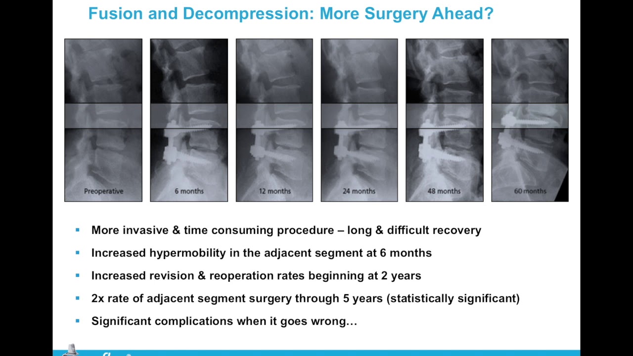 IINN Grand Rounds: "Coflex Interlaminar Stabilization: History ...