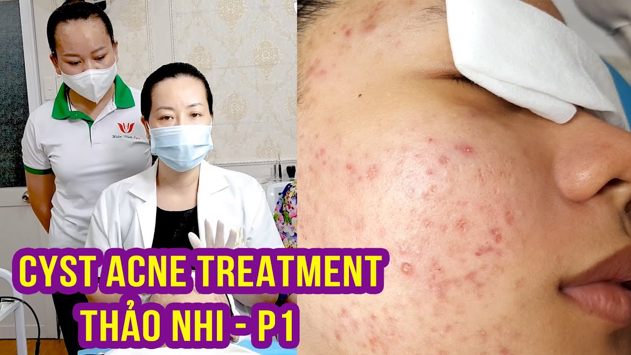 Cyst Acne Treatment | Điều trị mụn hiệu quả số 1 Hiền Vân Spa | Thảo ...