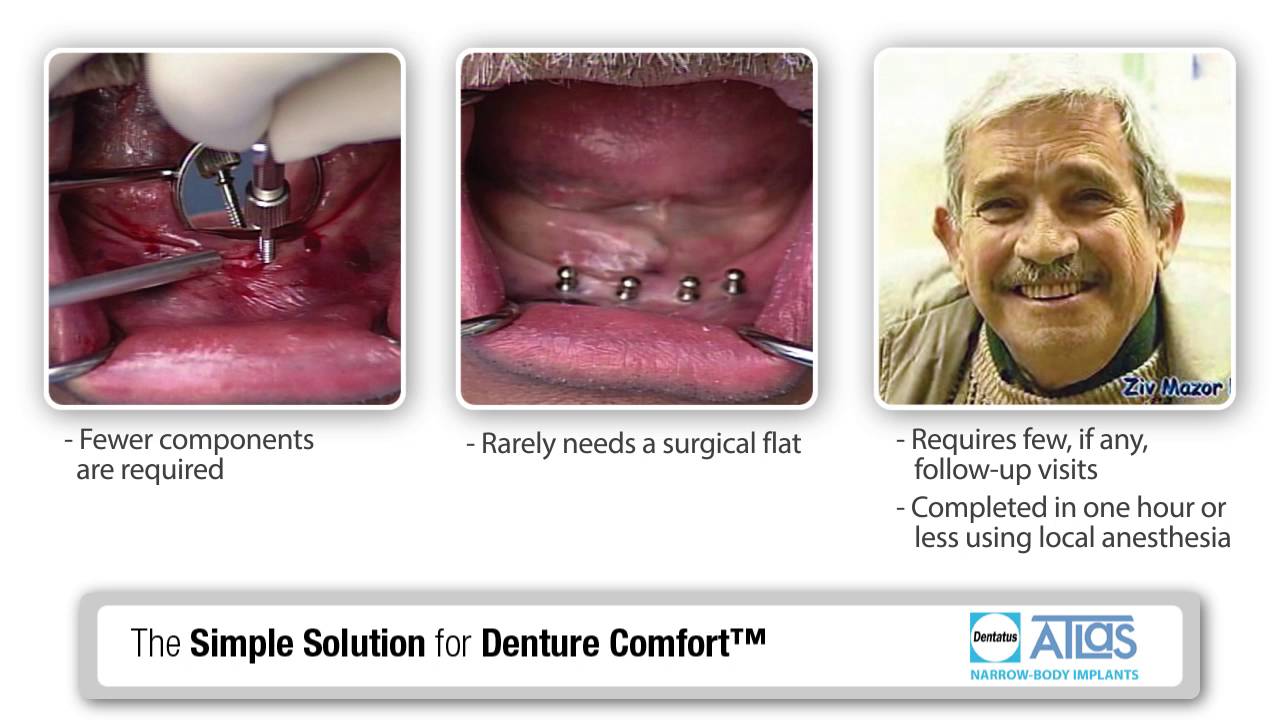 Dentatus Implant Video - YouTube