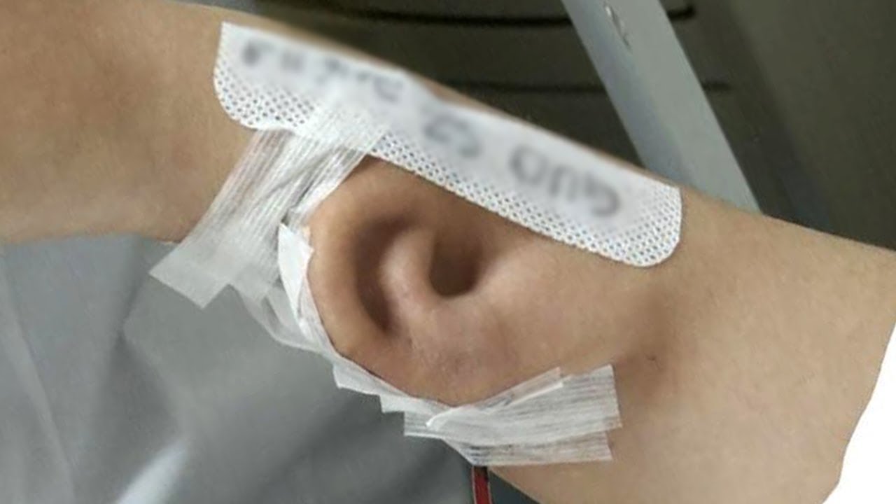Doctors Grow Replacement Ear INSIDE Woman’s Arm - YouTube