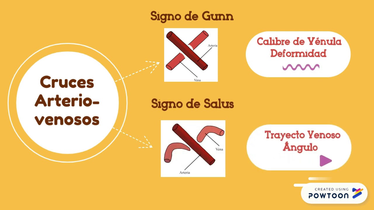 Fondo de ojo: Retinopatía Diabética y Retinopatía Hipertensiva - YouTube