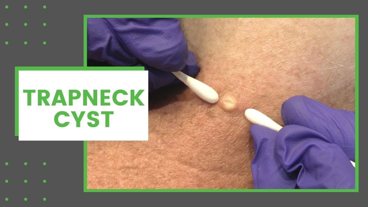 Trapneck Cyst | Dr. Derm - YouTube