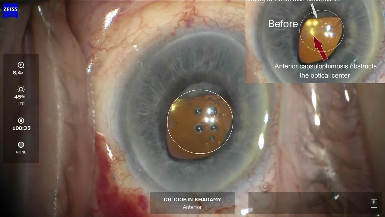 Minimal Surgery for Capsular Phimosis: Restoring Vision Without IOL ...