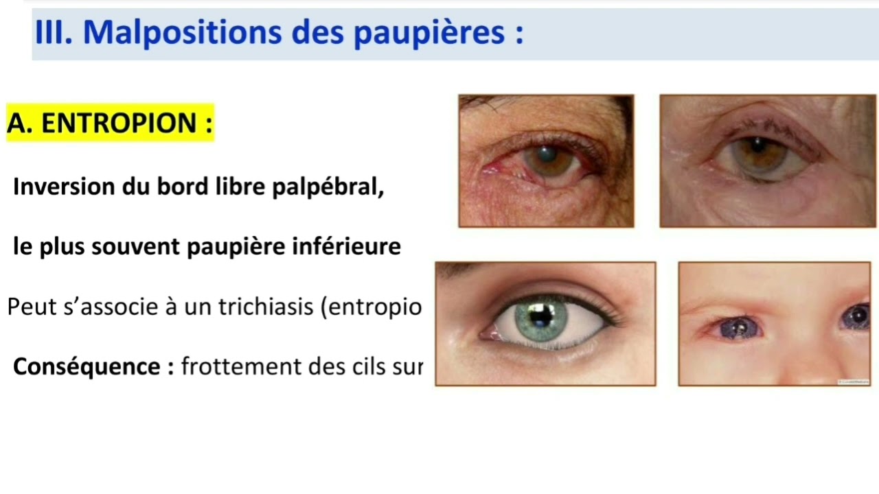 pathologie des paupières et de l appareil lacrymal - YouTube