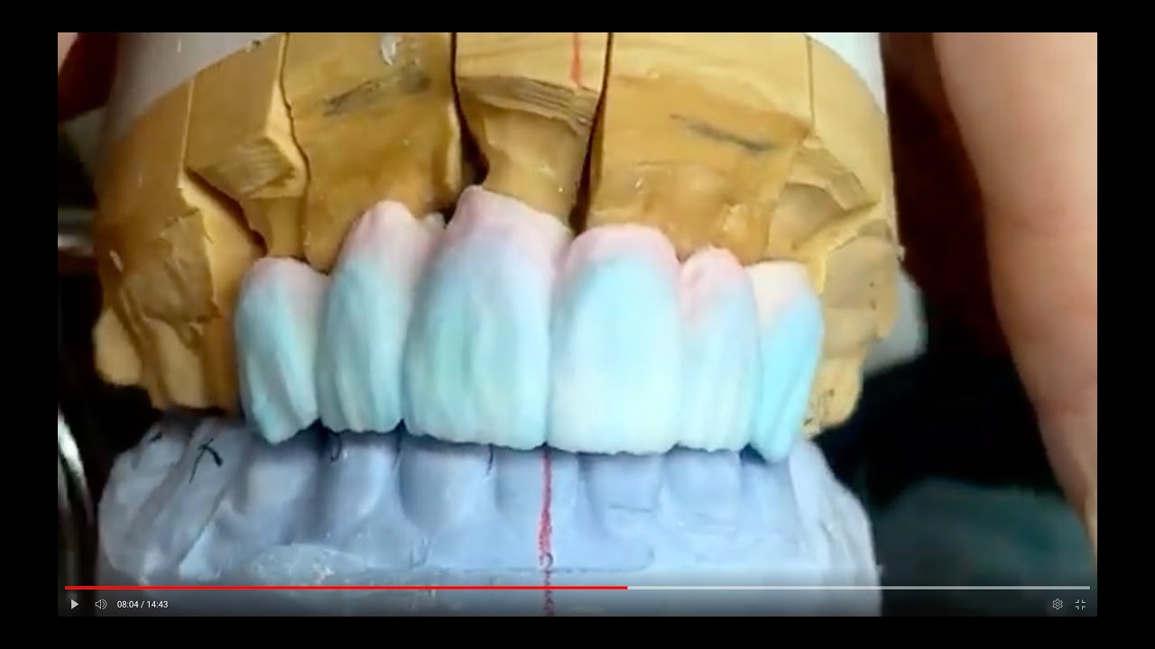 6 Unit Anterior Bridge Cleft Palate Case - YouTube
