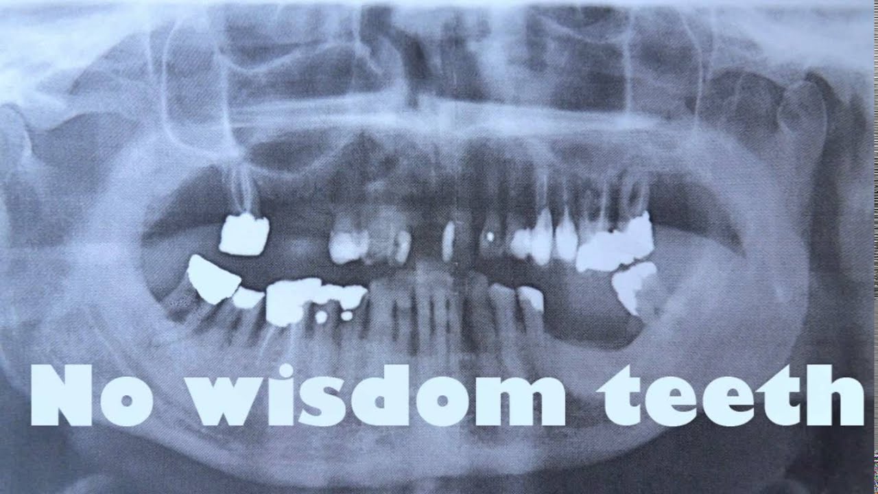 No wisdom teeth - YouTube