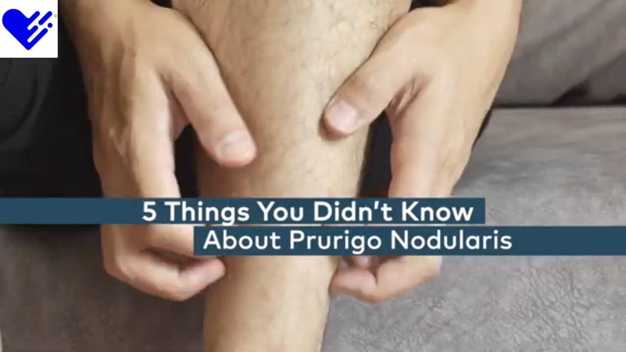 5 Things You Didn’t Know About Prurigo Nodularis | Healthgrades - YouTube