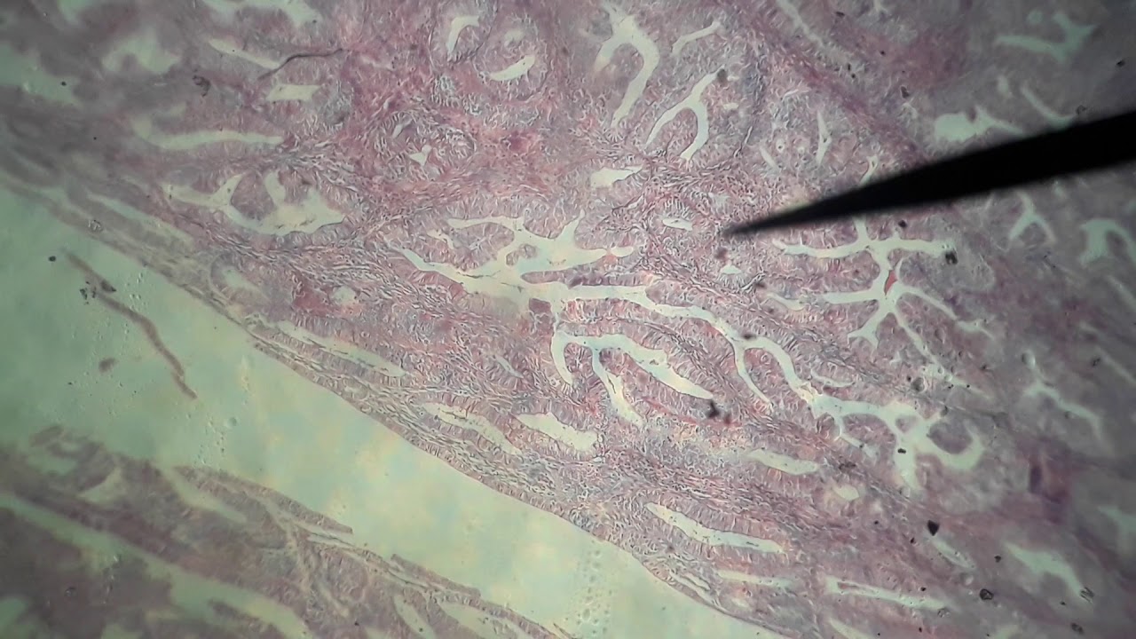 15- سرطانة غشاء باطن الرحم الغدية Endometrioid adenocarcinoma, uterus ...