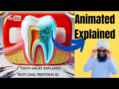 Tooth Decay, Animated Dental Video | Root Canal Treatment Video, RCT ...