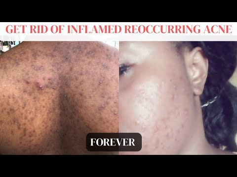 7 SUPER STEPS to Clear INFLAMED STUBBORN ACNE. Get Rid of ACNE ...