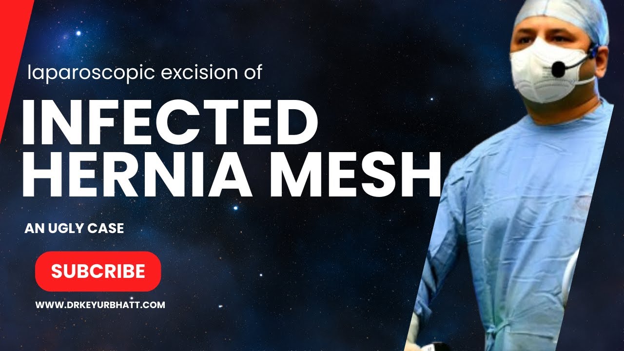 Mesh Infection | Laparoscopic Inguinal hernia Mesh removal | Dr Keyur ...