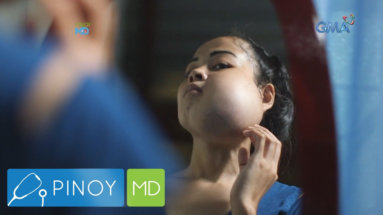 Pinoy MD: Ngipin na tumubo malapit sa lalamunan, susuriin! - YouTube