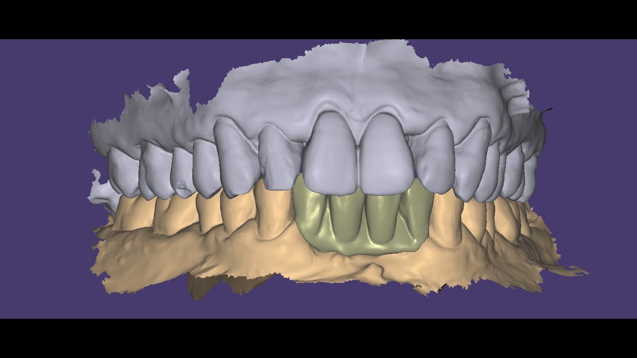 Lower posterior 3 unit bridge - pmma designing in exocad - YouTube