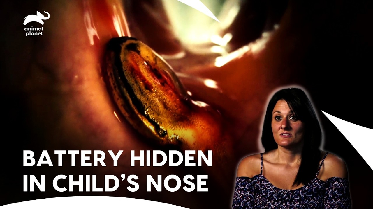 Child Swallow Battery, which Sends Electrical Currents in Body ...