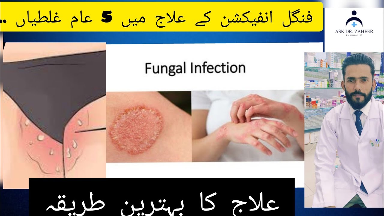 Fungus infection|Ringworm|mistakes during treatment of ringworm|Daad ka ...