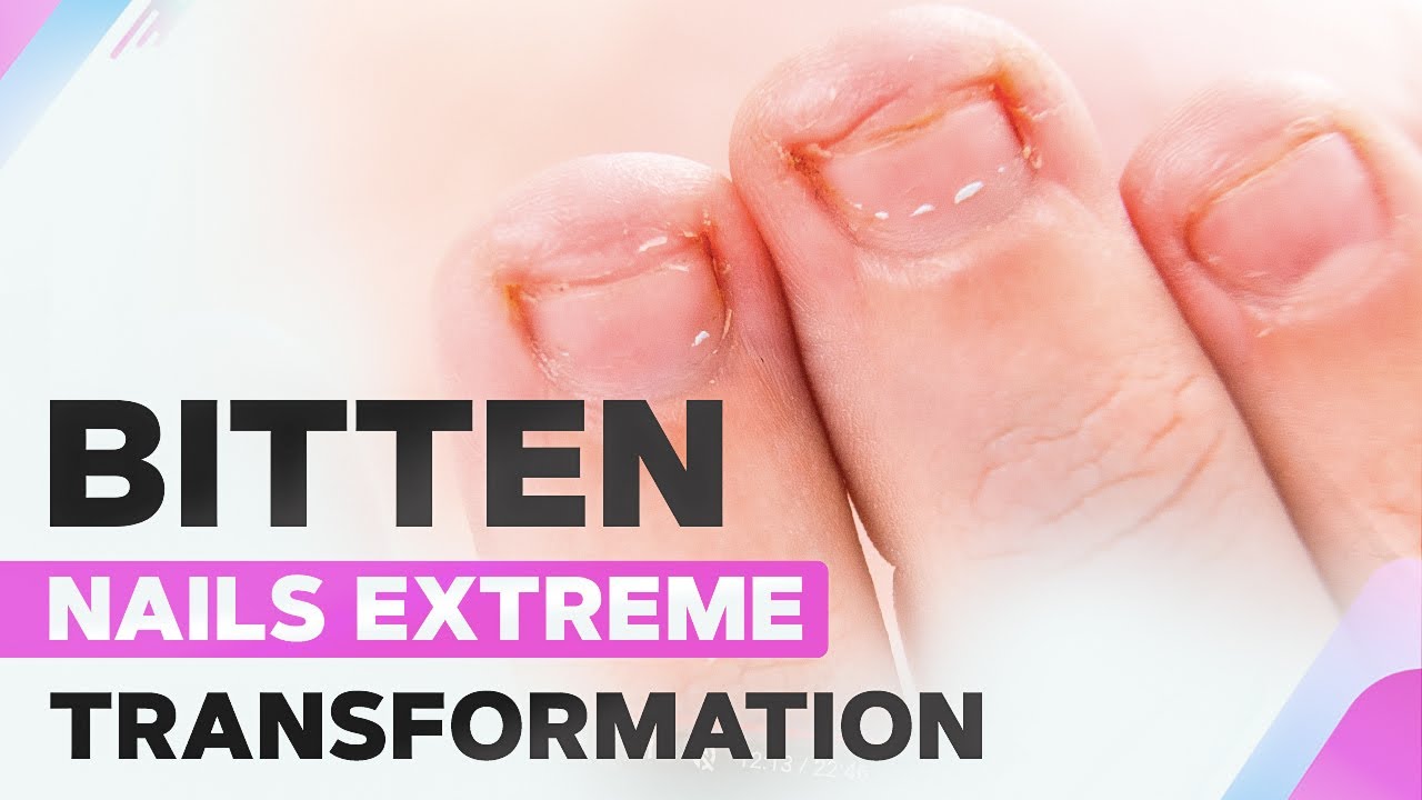 Badly Bitten Nails Transformation | Wet Sensitive Cuticle | Acrygel ...