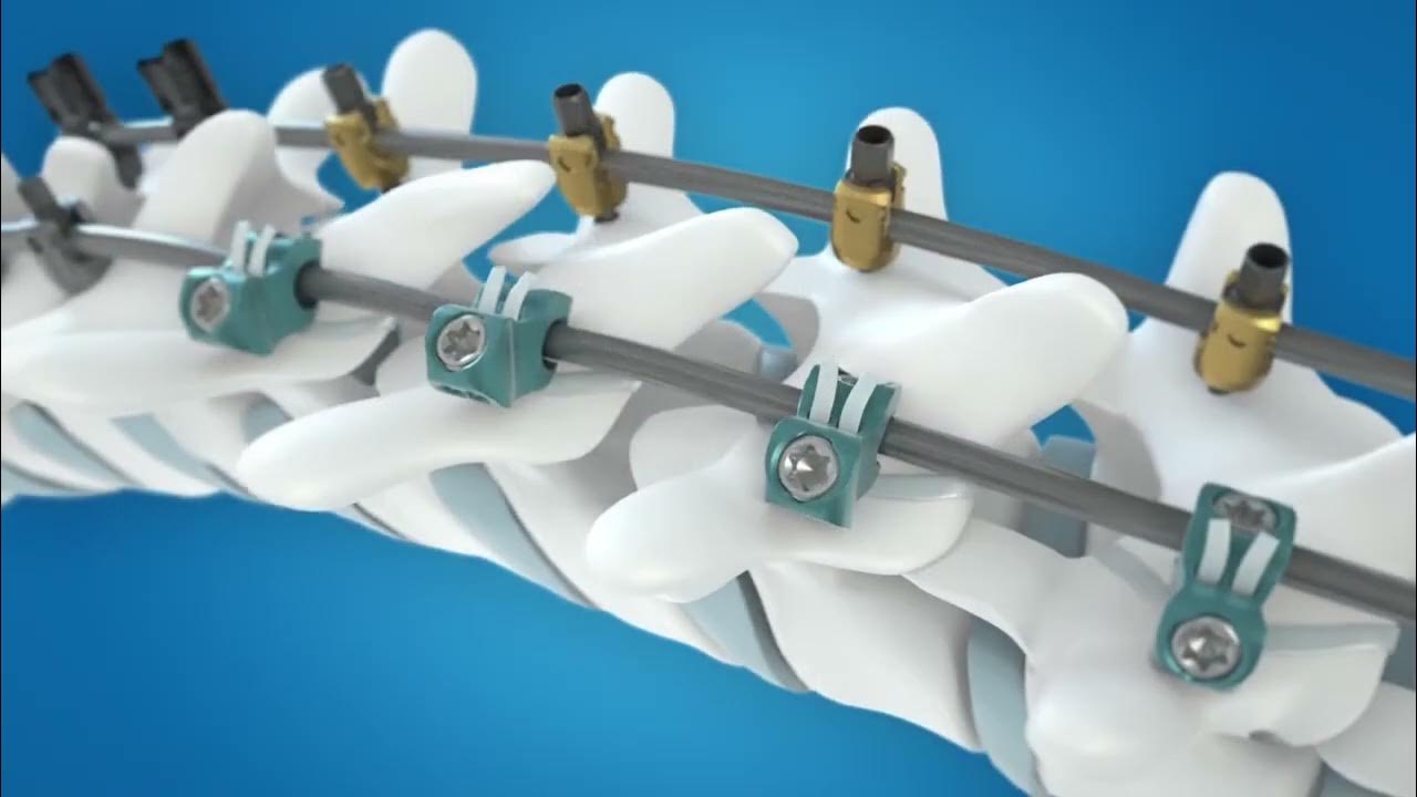 Medtronic: LigaPASS™ 2 0 Band Connectors - YouTube