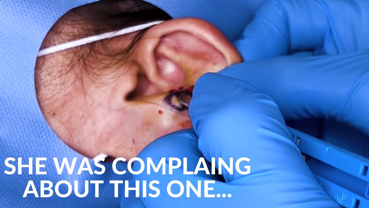 She's Been Waiting For This Ear Cyst Removal! - YouTube