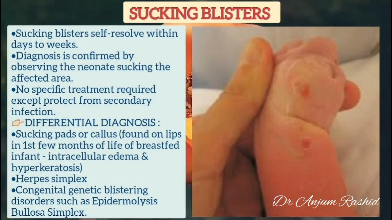 Sucking Blisters What Are They How To Treat Newborn Benign Skin sucking-blisters-what-are-they-how-to-treat-newborn-benign-skin