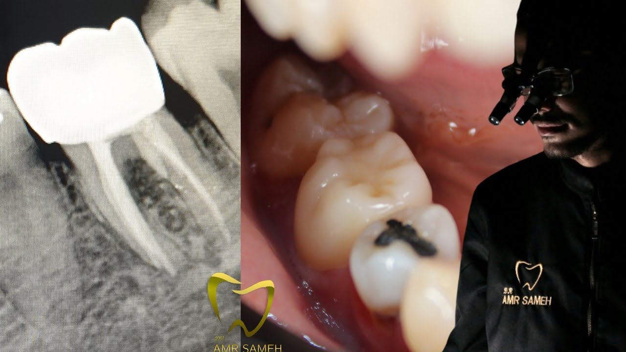 Furcation Perforation Repair Protocol + Restoring Badly Destructed ...