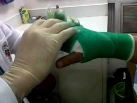 Liquid gel gauze that solidifies into fiberglass cast - YouTube