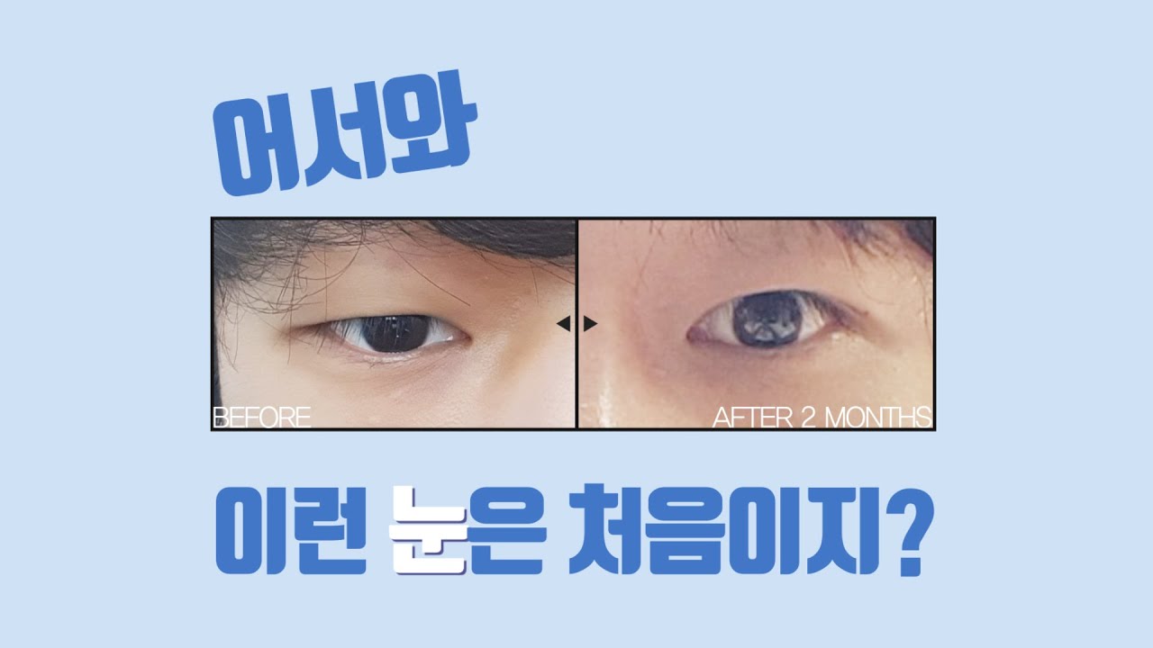 남자쌍수 남자눈매교정 후 어떻게 변했을까 남자성형전후 쌍수브이로그 눈수술후기 눈성형후기 쌍수후기 Youtube