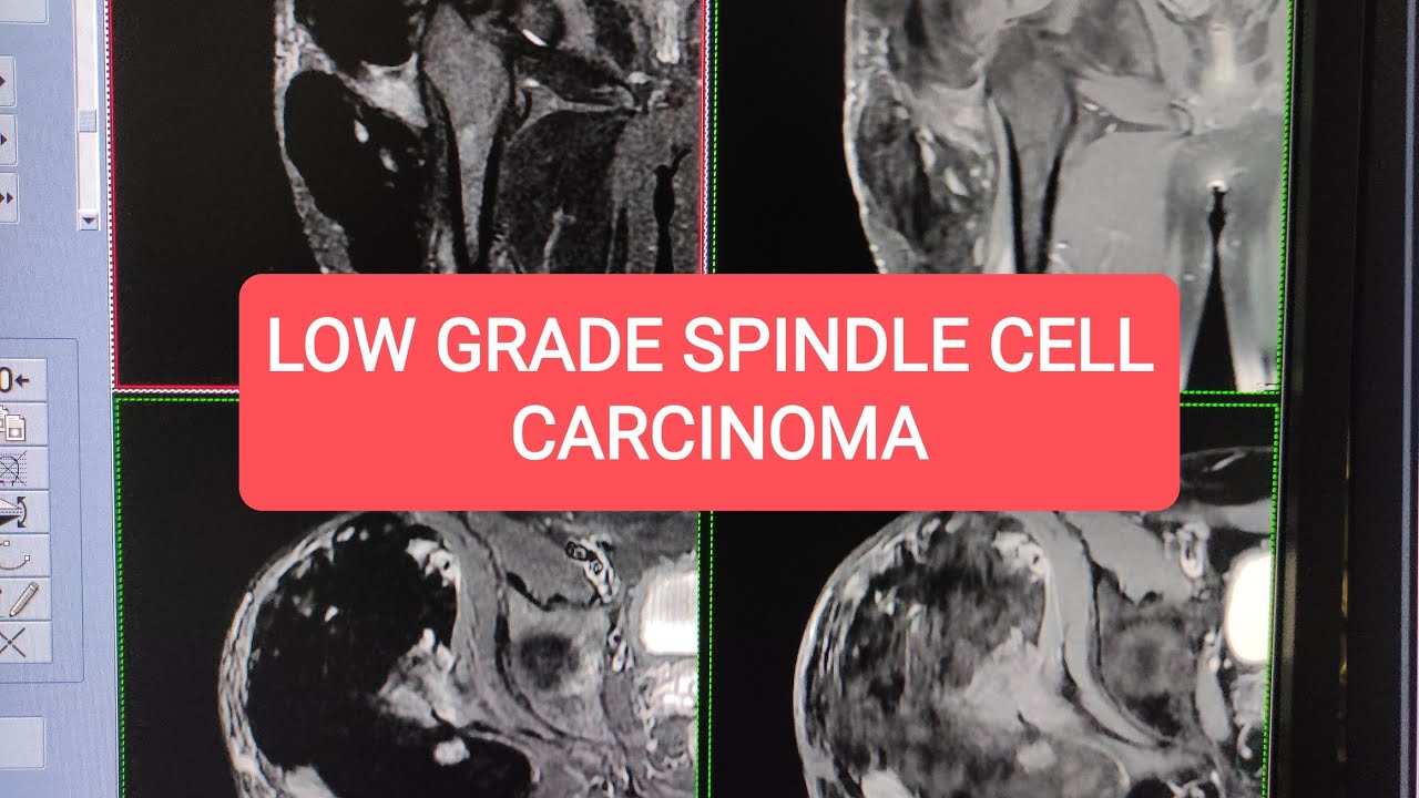 Low Grade Spindle Cell Carcinoma - MRI Thigh with Contrast - YouTube
