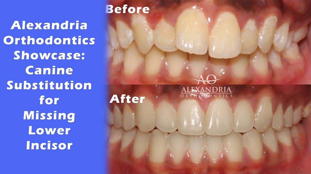 Alexandria Orthodontics Showcase: Missing lower incisor⁠ - YouTube
