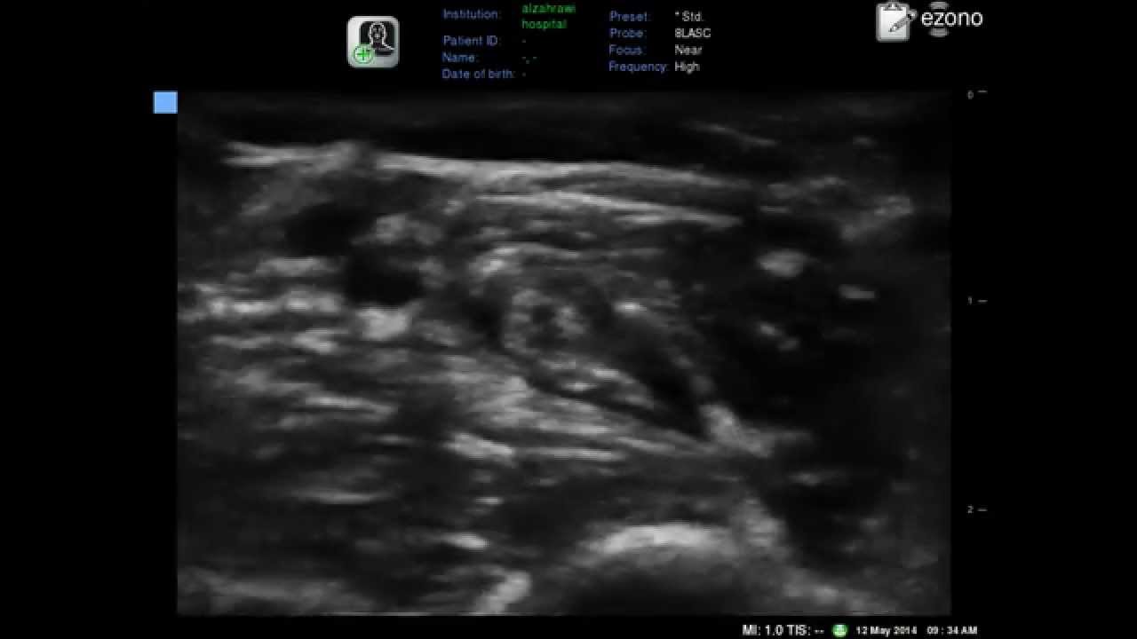 ultrasound guided median nerve block in forearm - YouTube