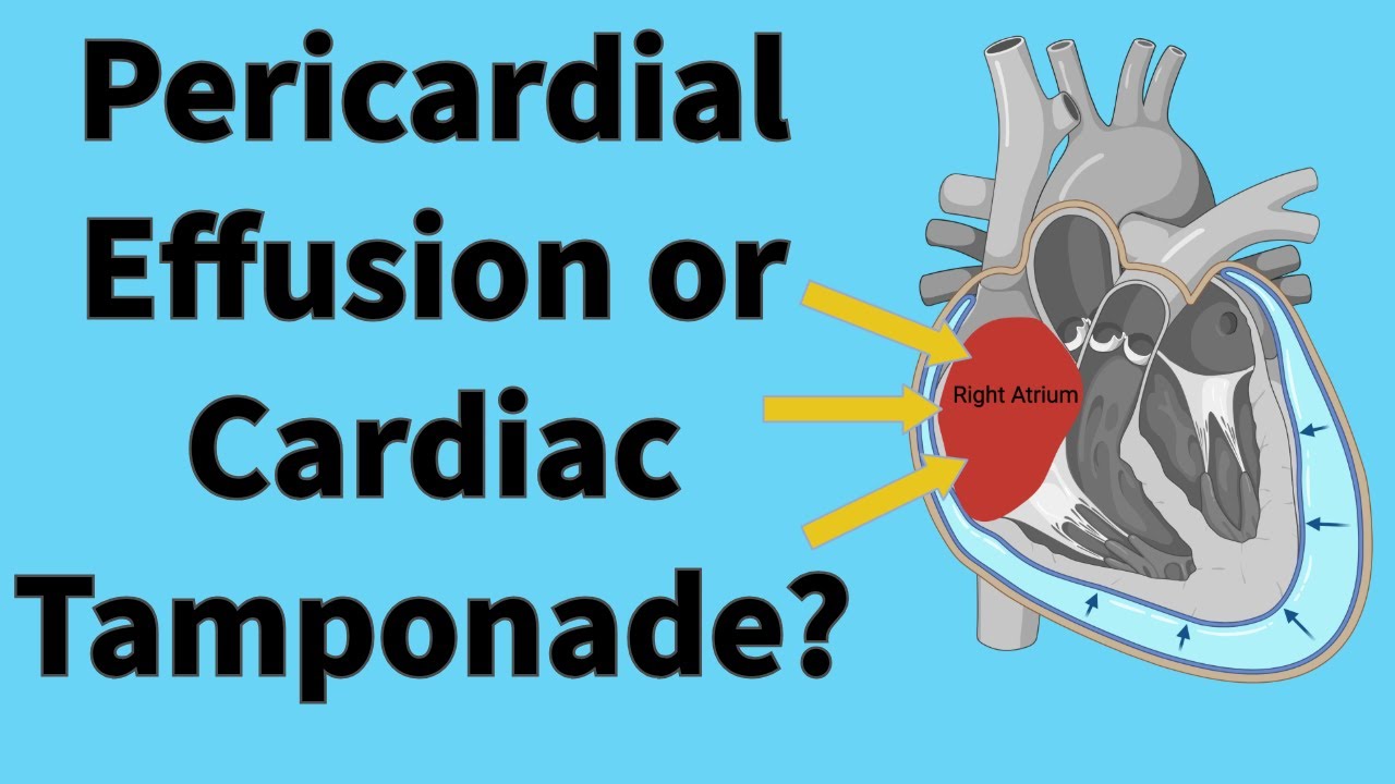 Cardiac Tamponade Diagram Cardiac Tamponade — Inside The Silver