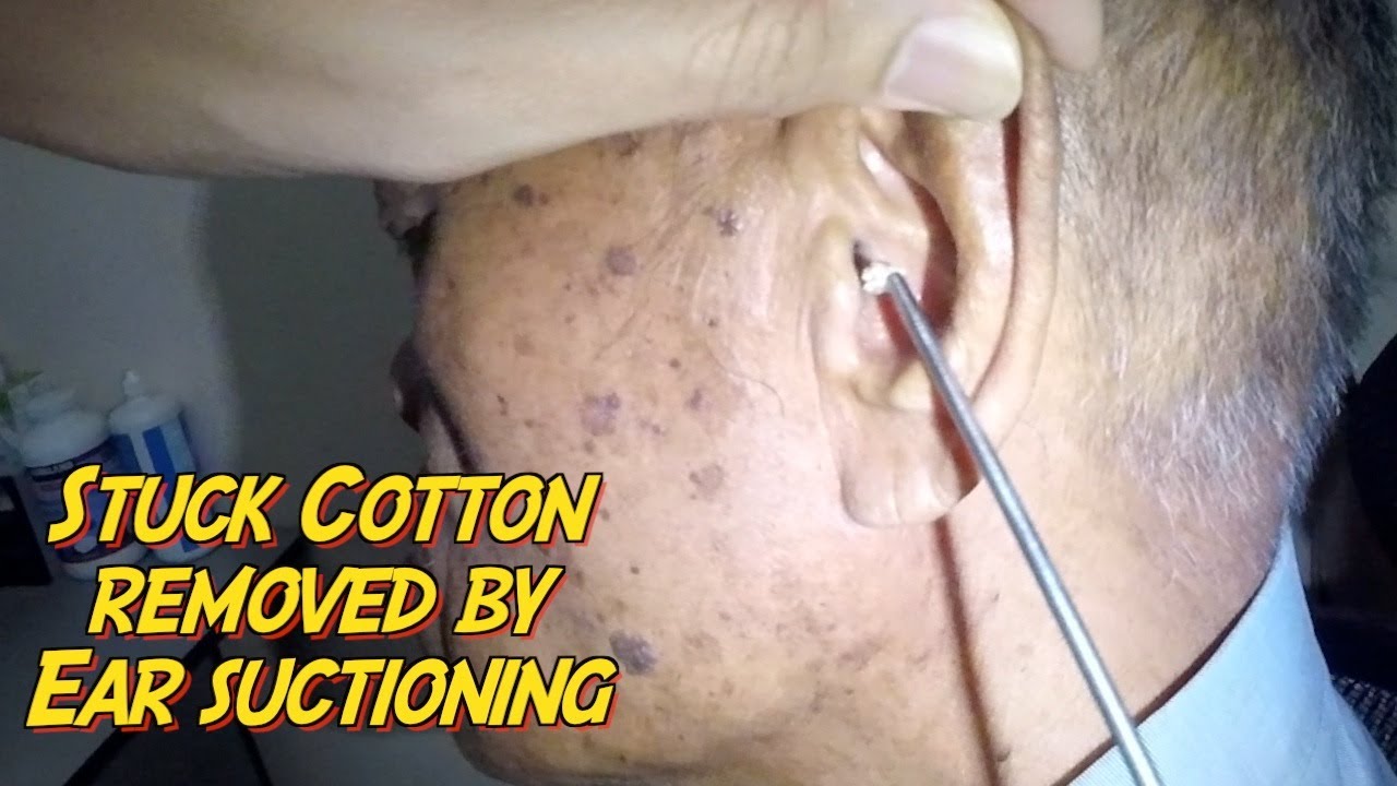 Elderly Man's Stuck Cotton Inside his Ear Removed after 1 Month - YouTube