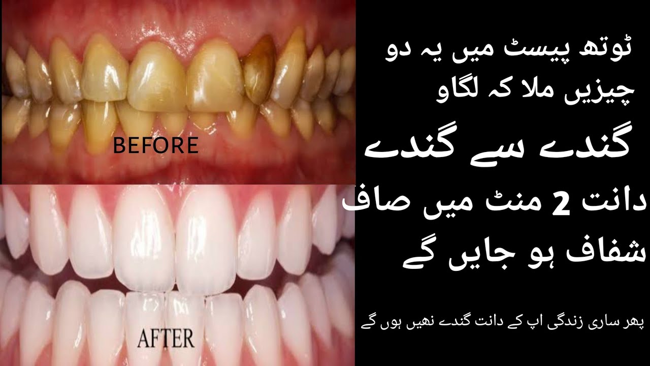 Clean Dirty To Dirty Teeth In 2 mint With Milk | Teeth Whiteing In 2 ...