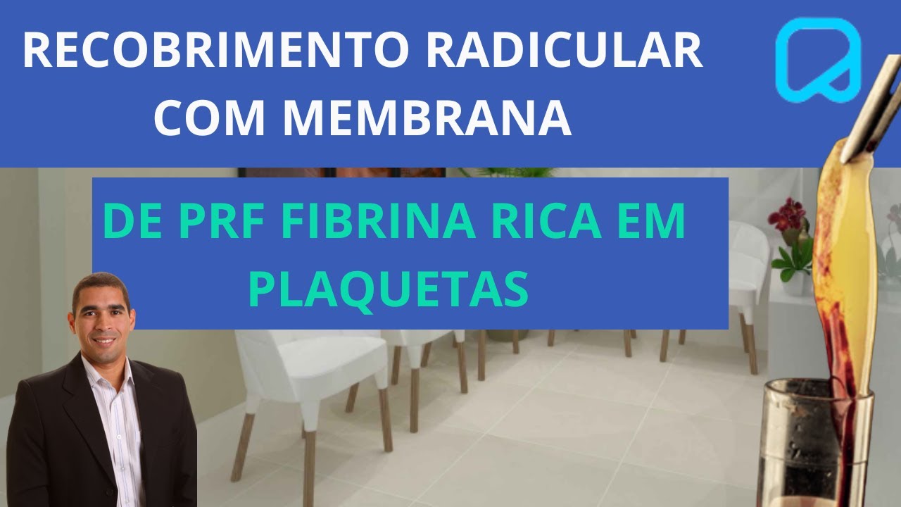 RECOBRIMENTO RADICULAR COM MEMBRANA DE PRF FIBRINA RICA EM PLAQUETAS ...