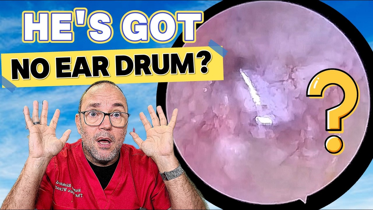 He's got No EAR DRUM?! Episode 595 (false fundus and exostosis) - YouTube