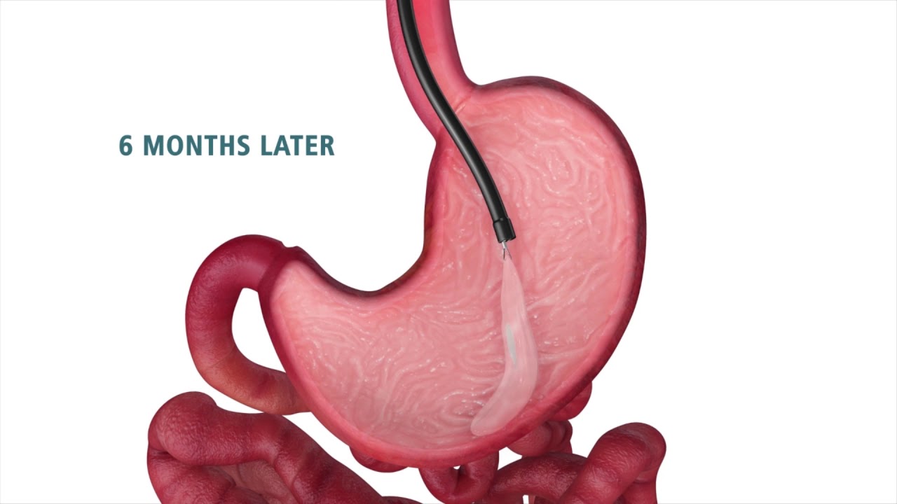 How Orbera Works - YouTube