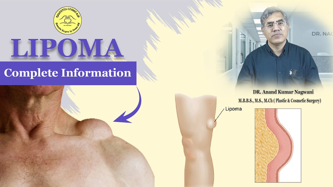 Lipoma Removal | Complete Information | Lipoma Surgery in Kolkata - By ...