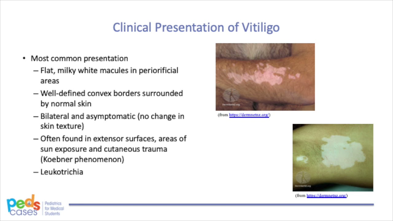Approach to Pediatric Vitiligo Video - YouTube