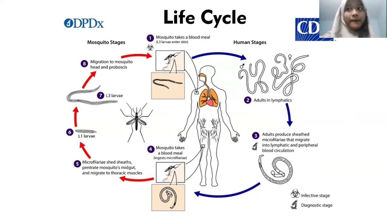 Filariasis (Definition, Risk Factor, Life Cycle, Clinical Features, and ...