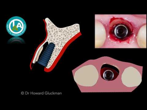 PET Socket shield step by step animation