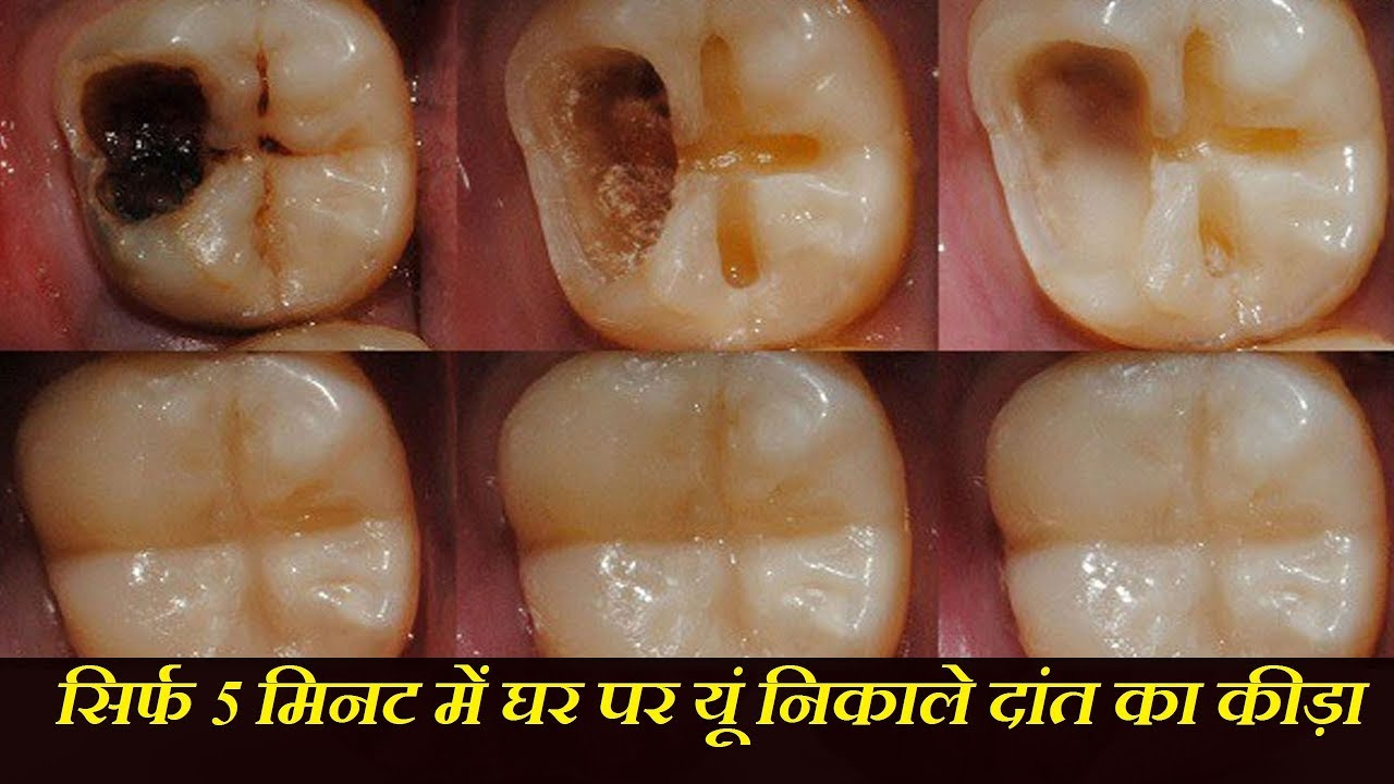 One Trick To Remove Tooth Bug At Home In 5 Minutes Permanently। दांतो ...