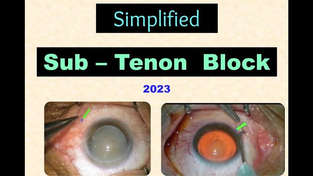 Simplified sub Tenon anesthesia( # 25 ) - YouTube