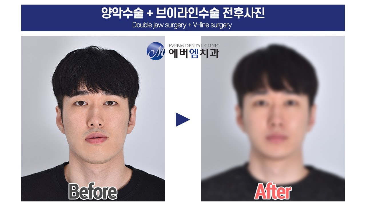 양악 V라인 전후영상 논현 구강악안면외과 에버엠치과 Youtube