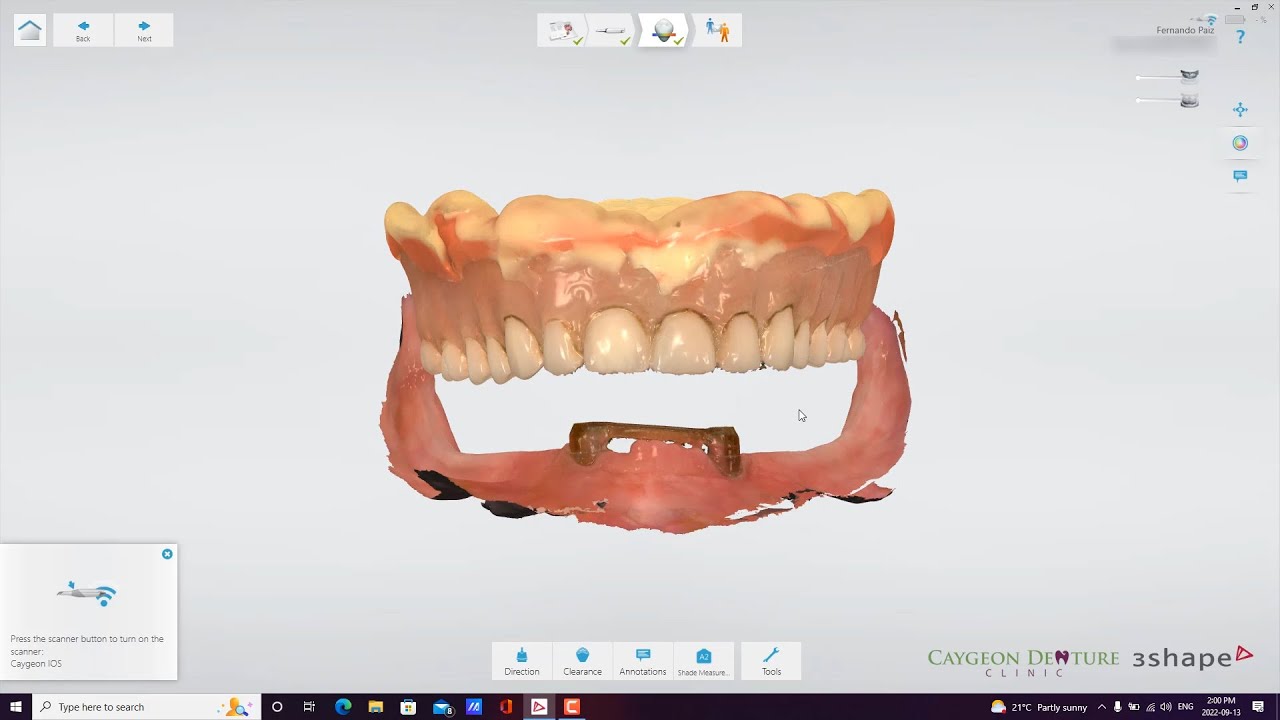 CUD-CLD with Dolder Bar Digital Scans - YouTube