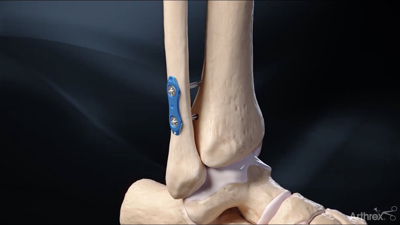 Arthrex Syndesmosis TightRope XP Implant System - YouTube