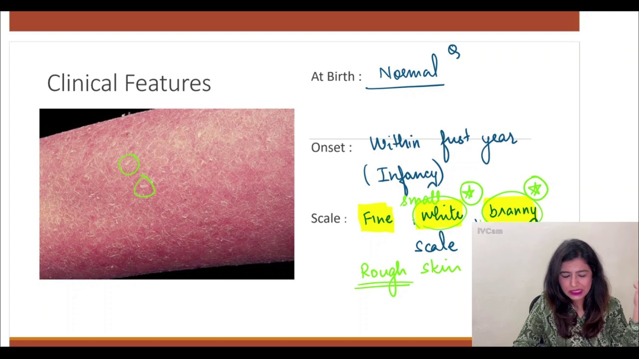 Ichthyosis, Cause, Clinical features, Diagnosis & Treatment , Disorder ...