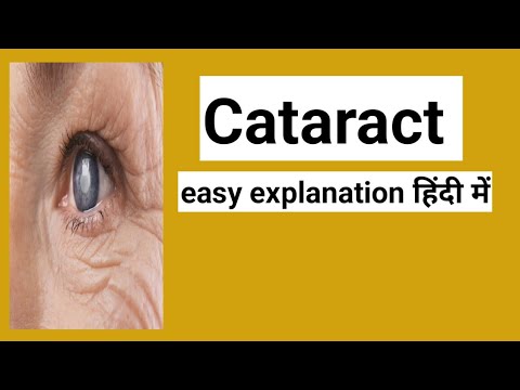Cataract/Nursing Notes/easy explanation in hindi/Medicalsurgicalnursing ...